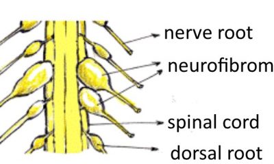 Improving the Lives of People with Neurofibromatosis - NF Midwest